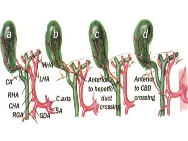Bile duct injuries | PPSX