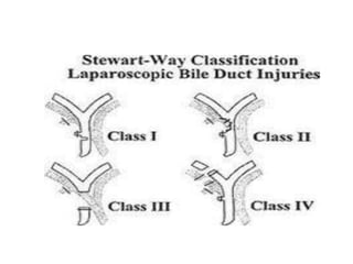 Stewart Way Classification
