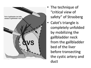 Triangle Of Calot Critical View