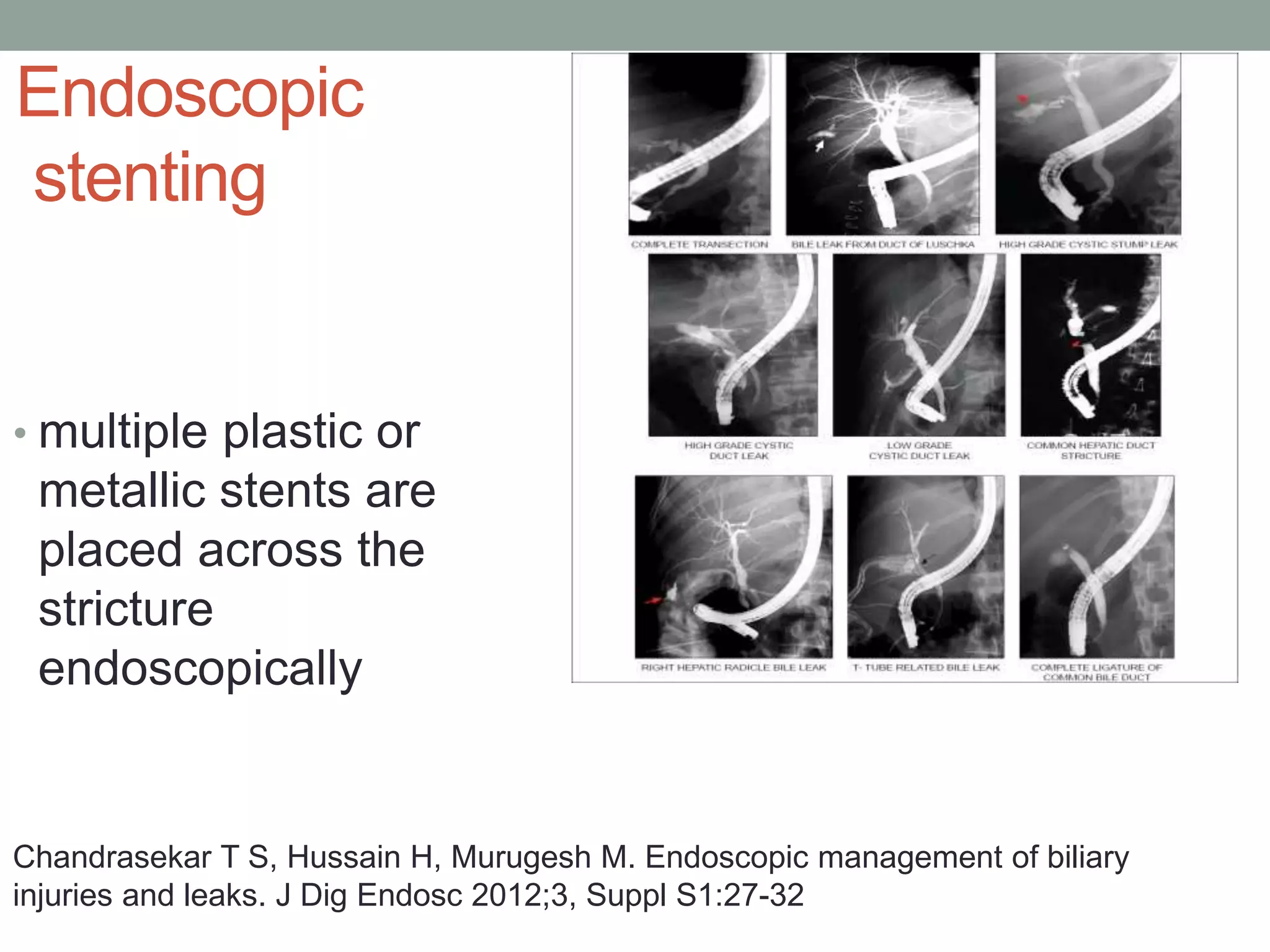 Bile duct injuries BDI | PPTX