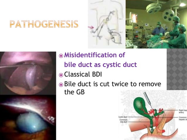 Bile duct injuries | PPTX | Digestive Disorders | Diseases and Conditions