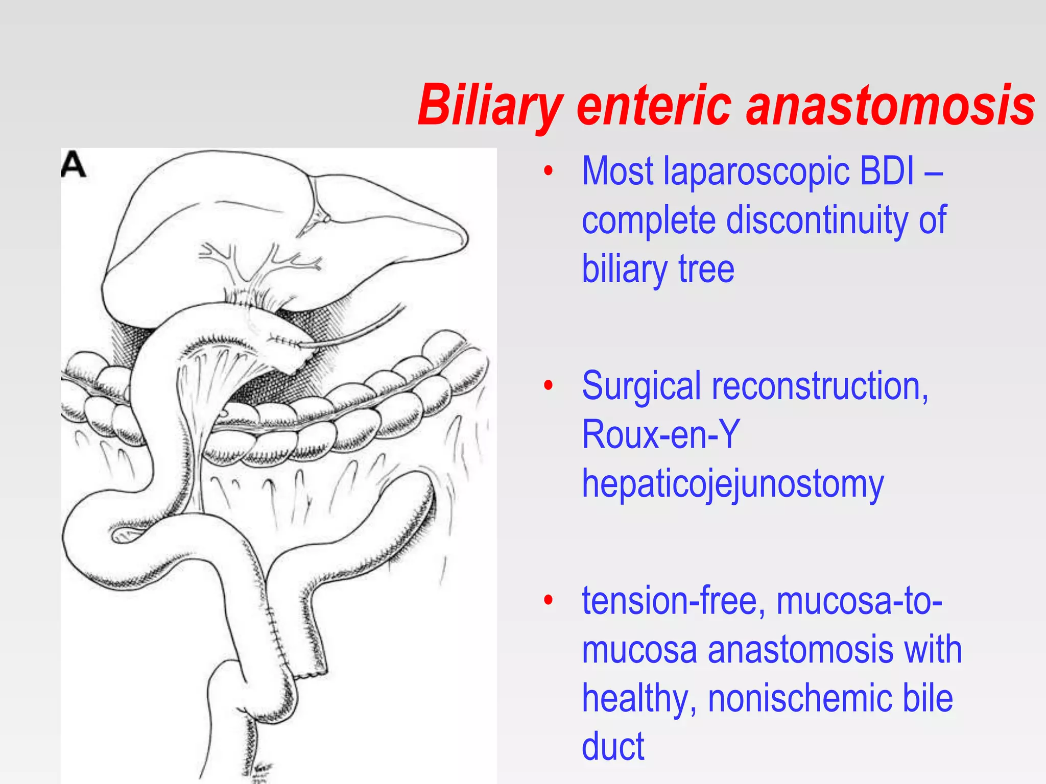Bile duct injuriesCBDstricture, biliary fistula.pptx