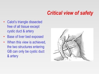 Triangle Of Calot Critical View