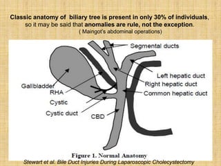 Bile duct injuries in Laparocsopic cholecystectomy | PPTX