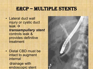 Bile duct injuries in Laparocsopic cholecystectomy | PPTX