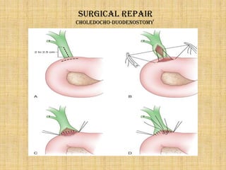 Bile duct injuries in Laparocsopic cholecystectomy | PPTX