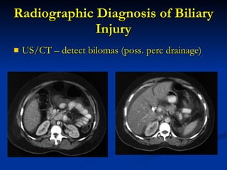Bile duct injury:How safe is emergency laparoscopic cholecystectomy? | PPT