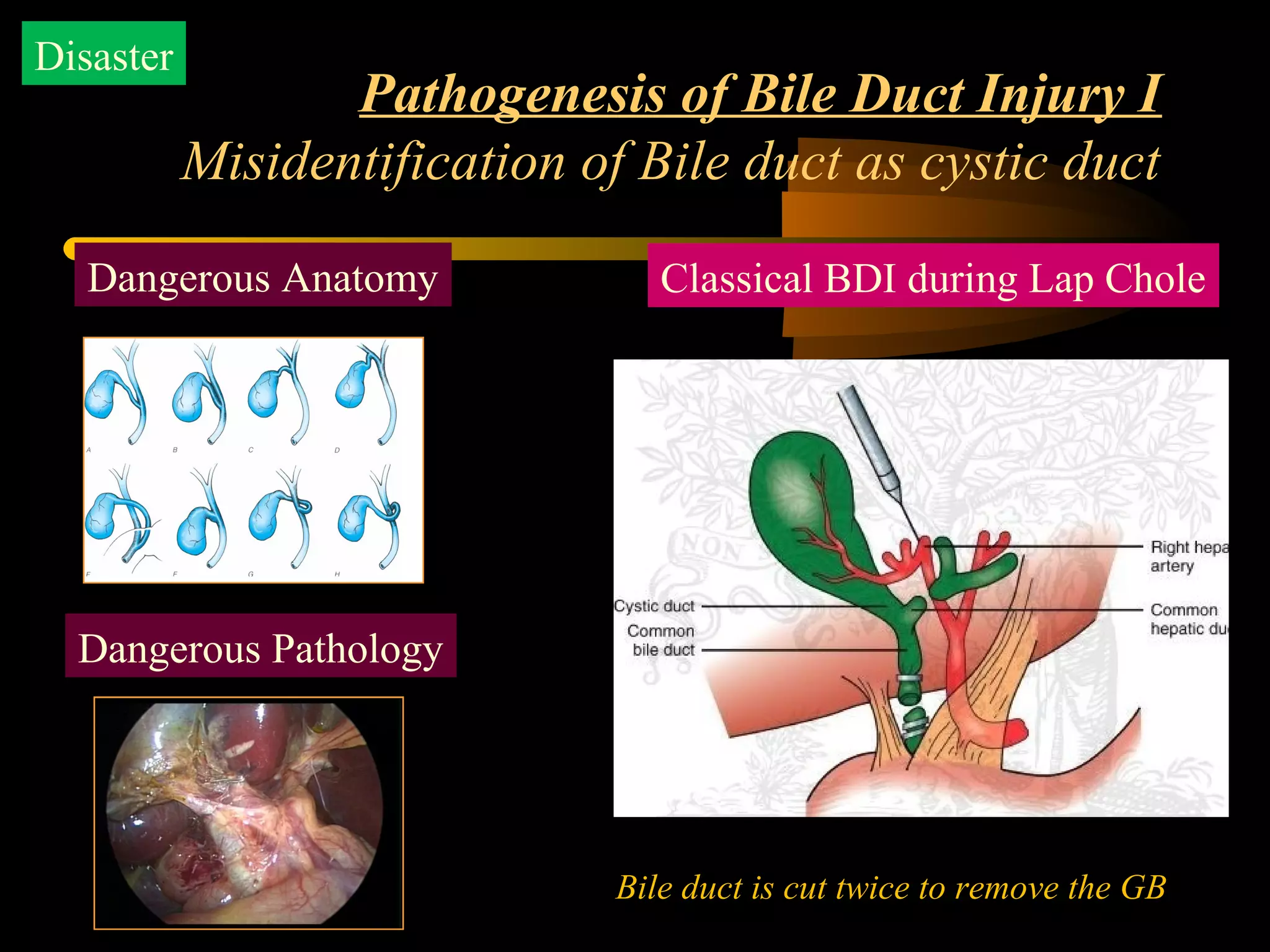 Bile duct injury during laparoscopic cholecystectomy | PPT