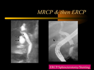 Bile duct injury during laparoscopic cholecystectomy | PPT