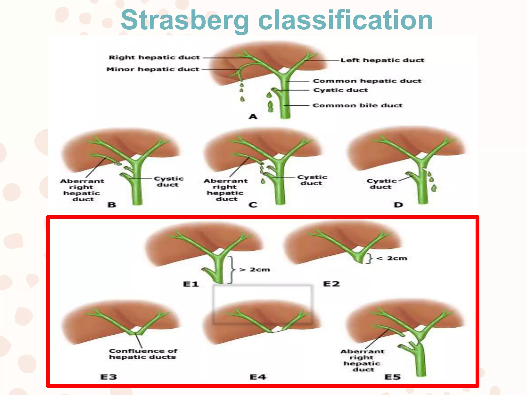 Bile duct injury | PPTX