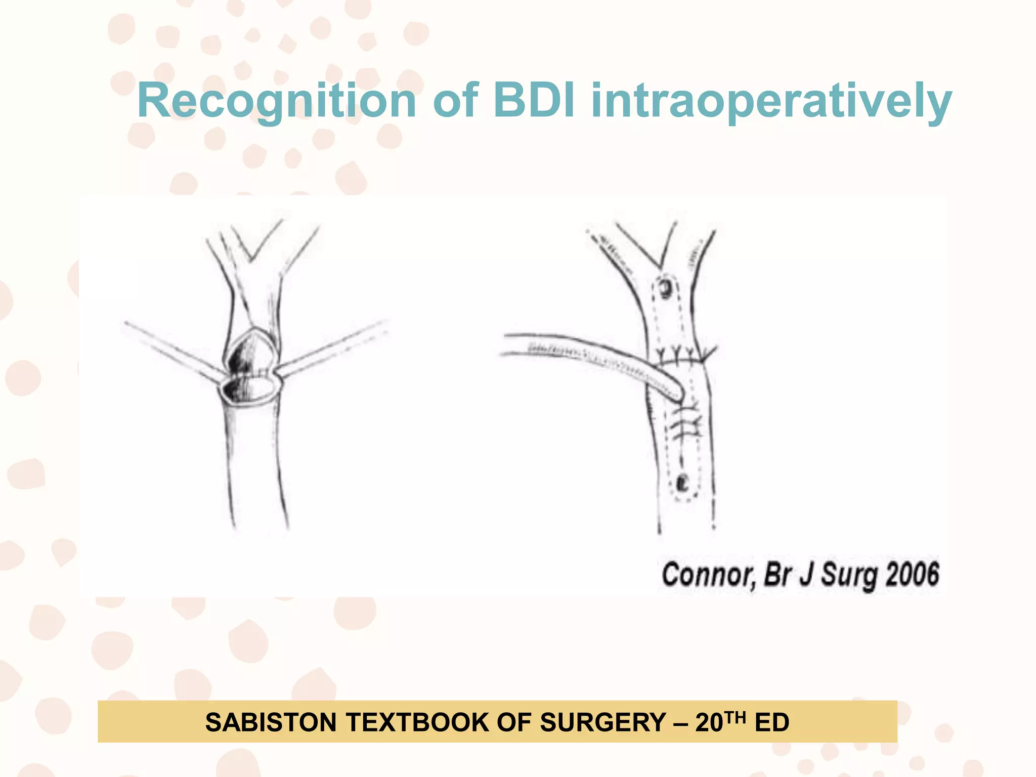 Bile duct injury | PPTX
