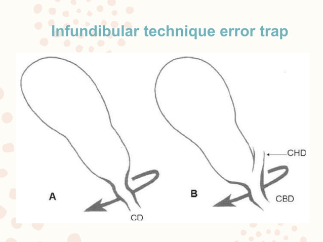 Bile duct injury | PPTX