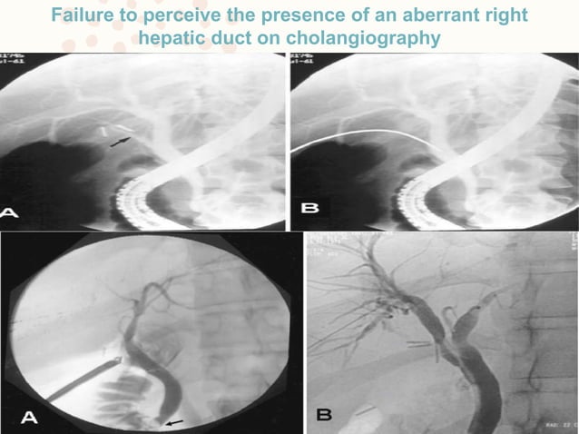 Bile duct injury | PPTX