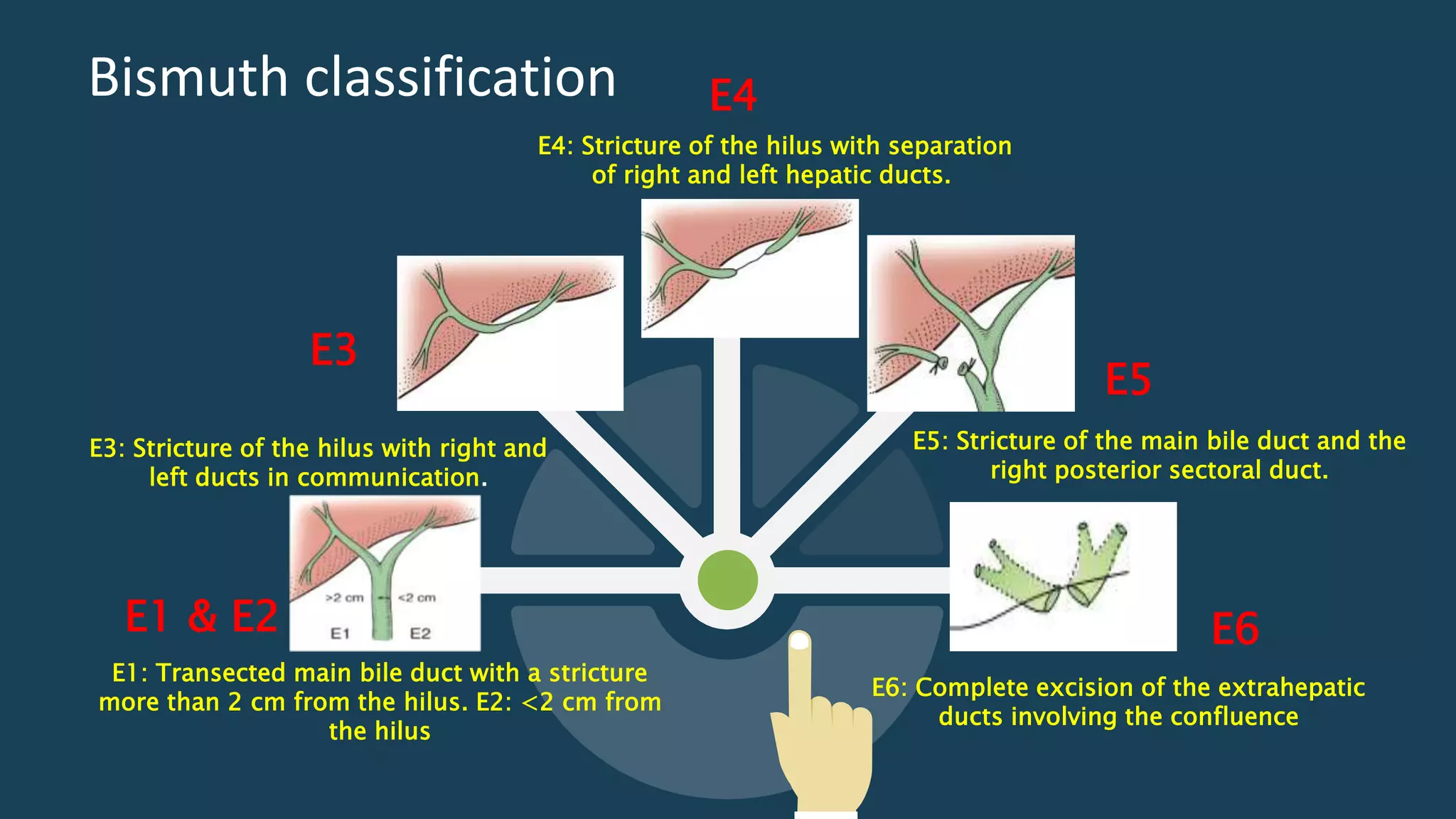 Bile Duct Injury and Post Cholecystectomy Biliary Stricture | PPTX