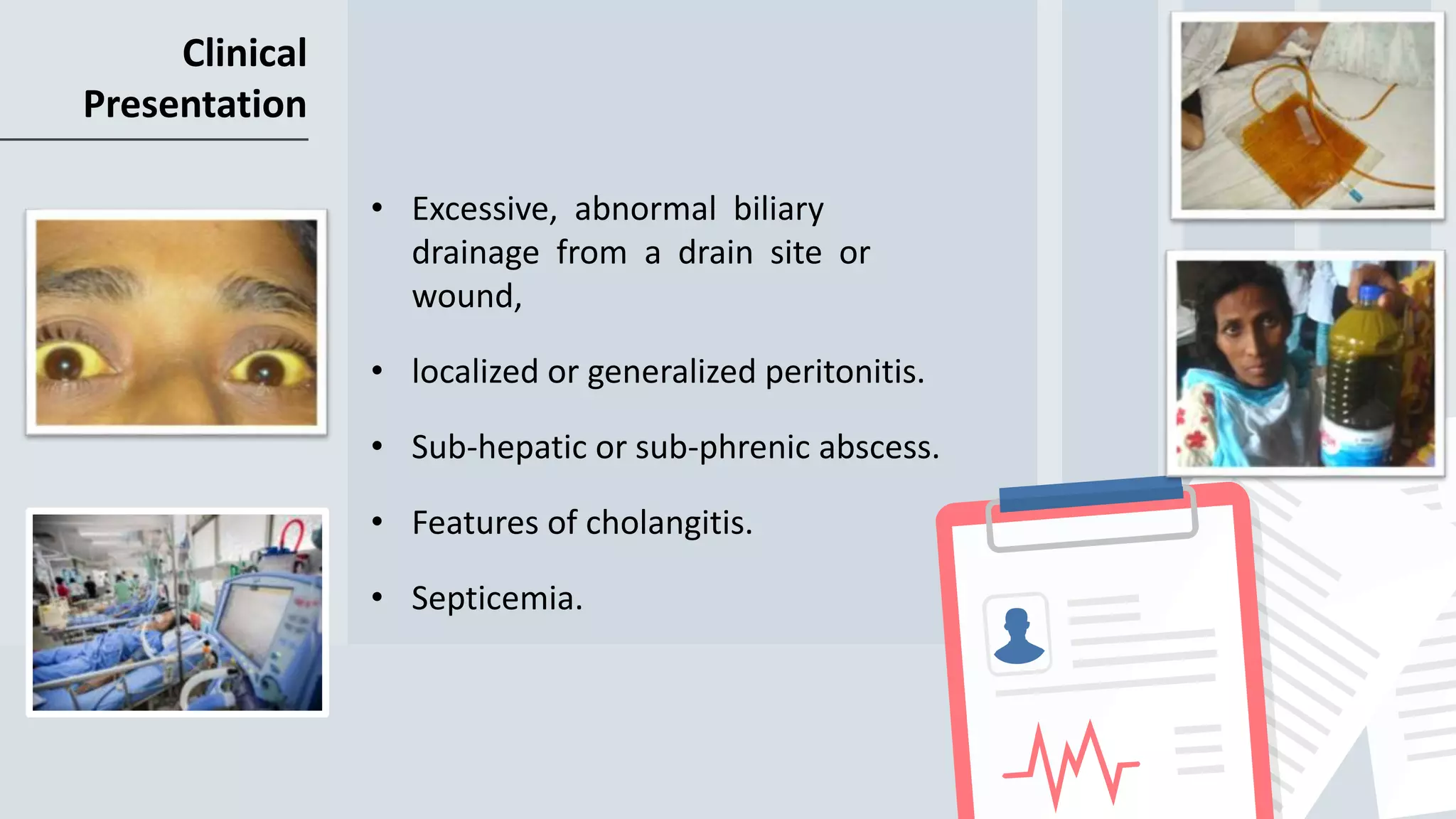 Bile Duct Injury and Post Cholecystectomy Biliary Stricture | PPTX