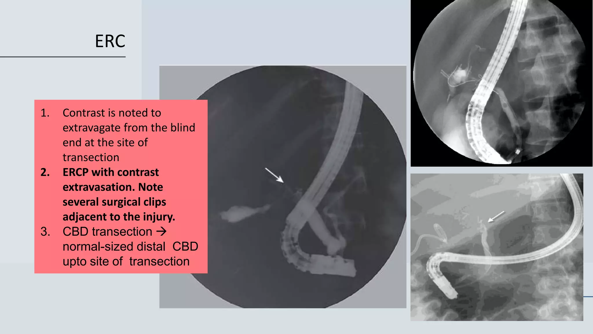 Bile Duct Injury and Post Cholecystectomy Biliary Stricture | PPTX