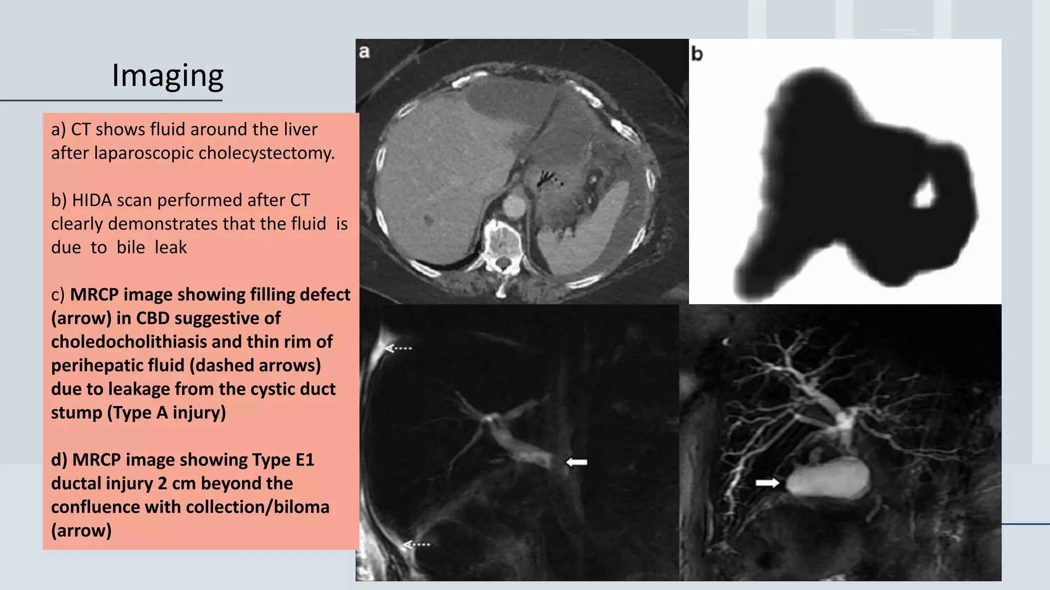 Bile Duct Injury and Post Cholecystectomy Biliary Stricture | PPTX