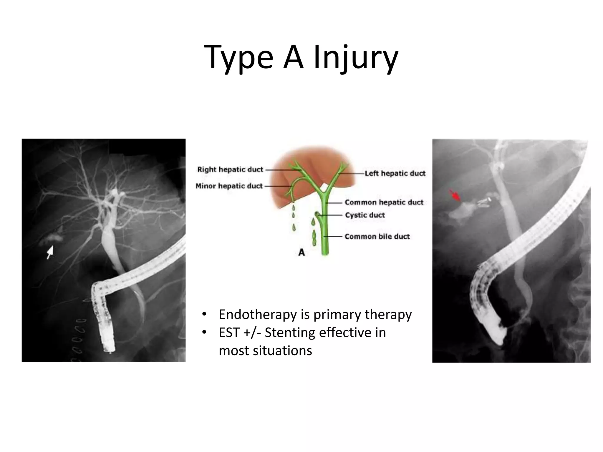 Bile duct injury | PPTX