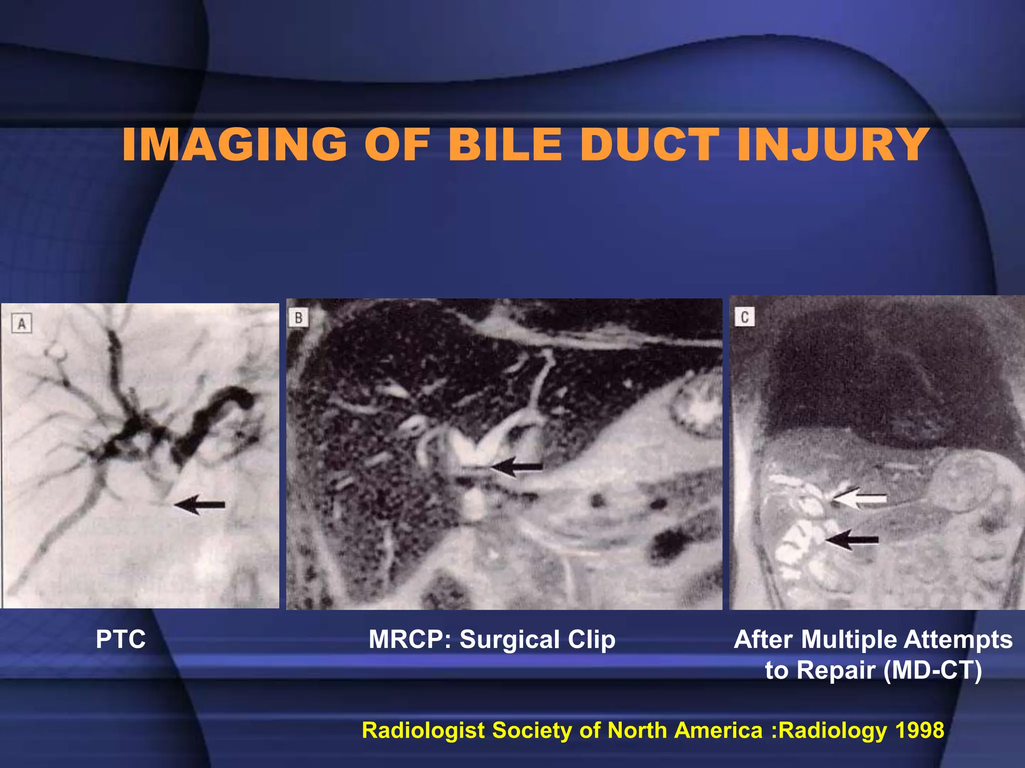 BILE DUCT INJURY 09-05.ppt