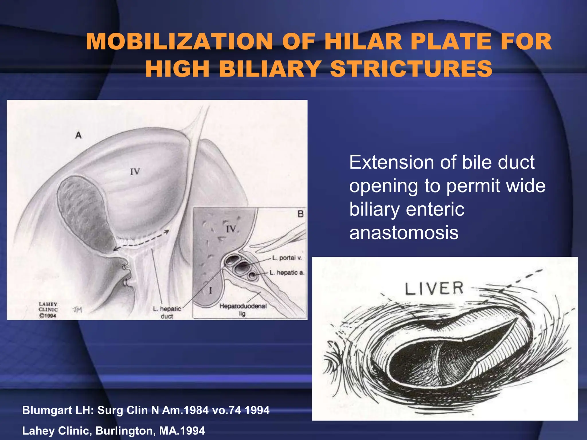 BILE DUCT INJURY 09-05.ppt
