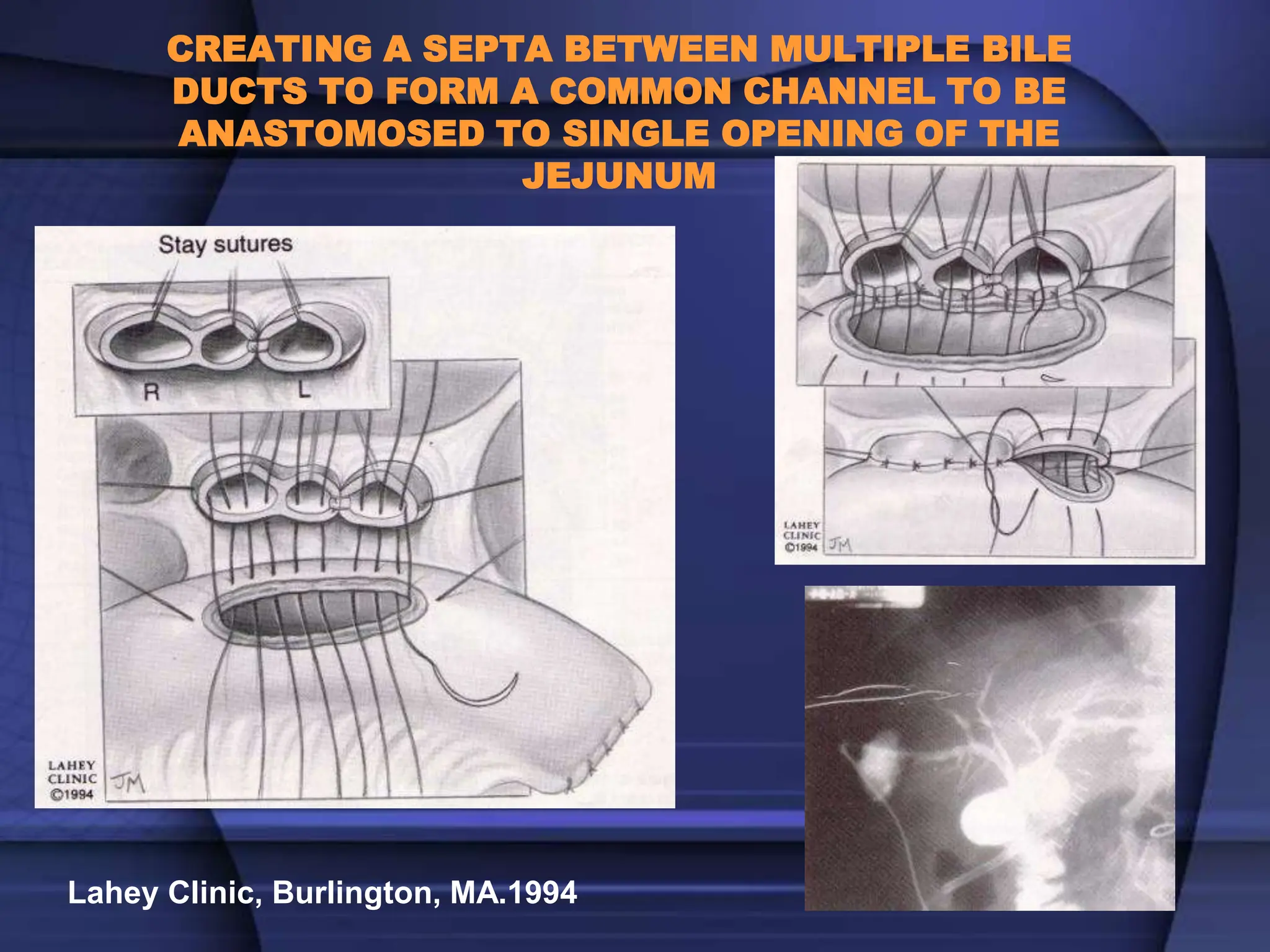 BILE DUCT INJURY 09-05.ppt