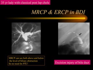 Bile duct injury case capsule bile duct injury.ppt
