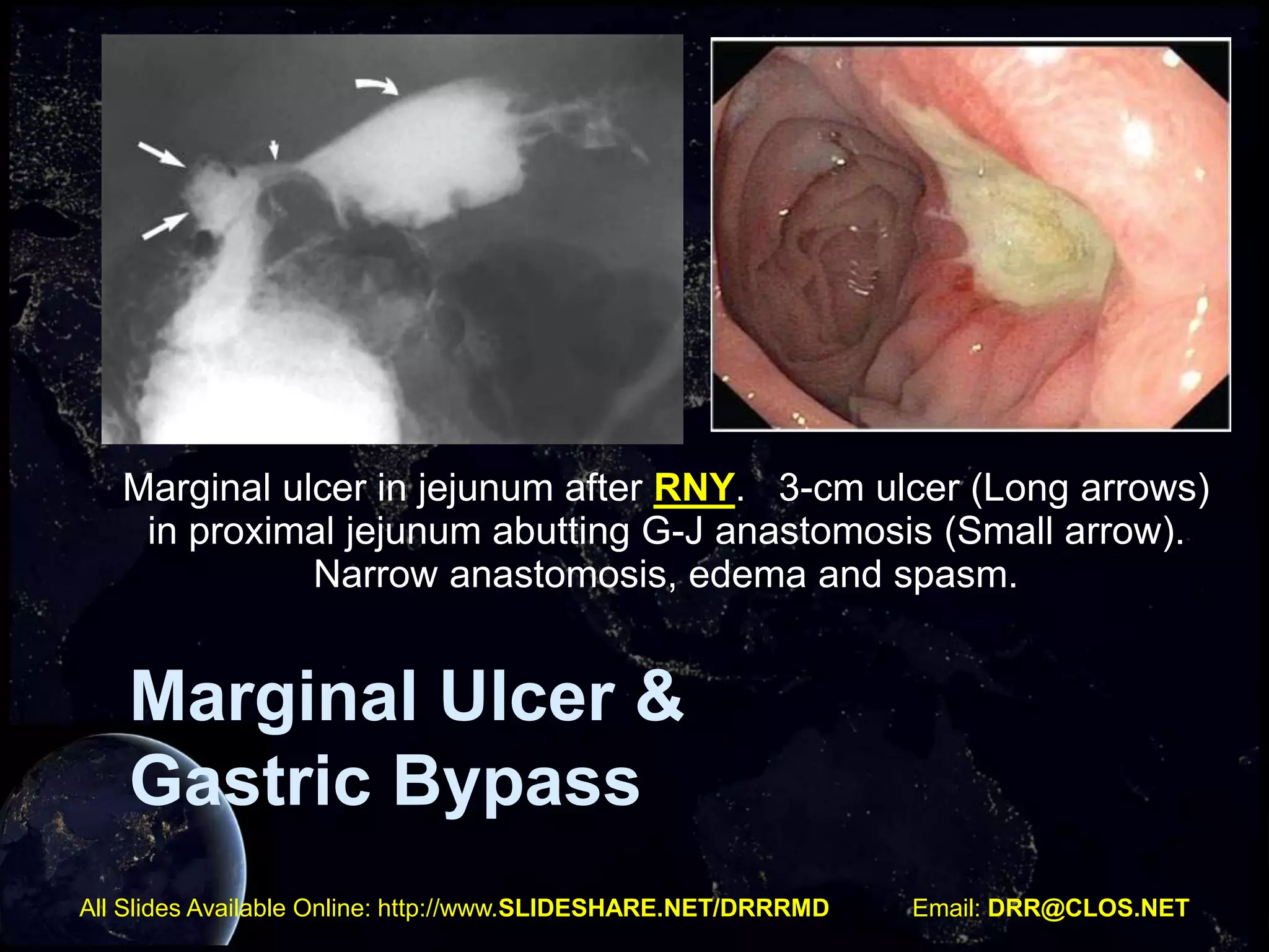 Bile reflux gastritis and marginal ulcer | PPTX