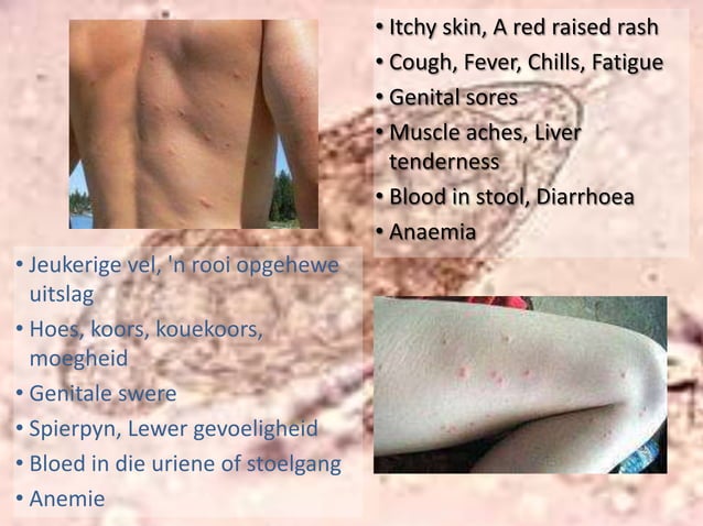 Bilharzia | PPTX | Infectious Diseases | Diseases and Conditions