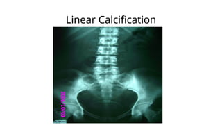 Urinary bilharziasis and urinary tract infection | PPT