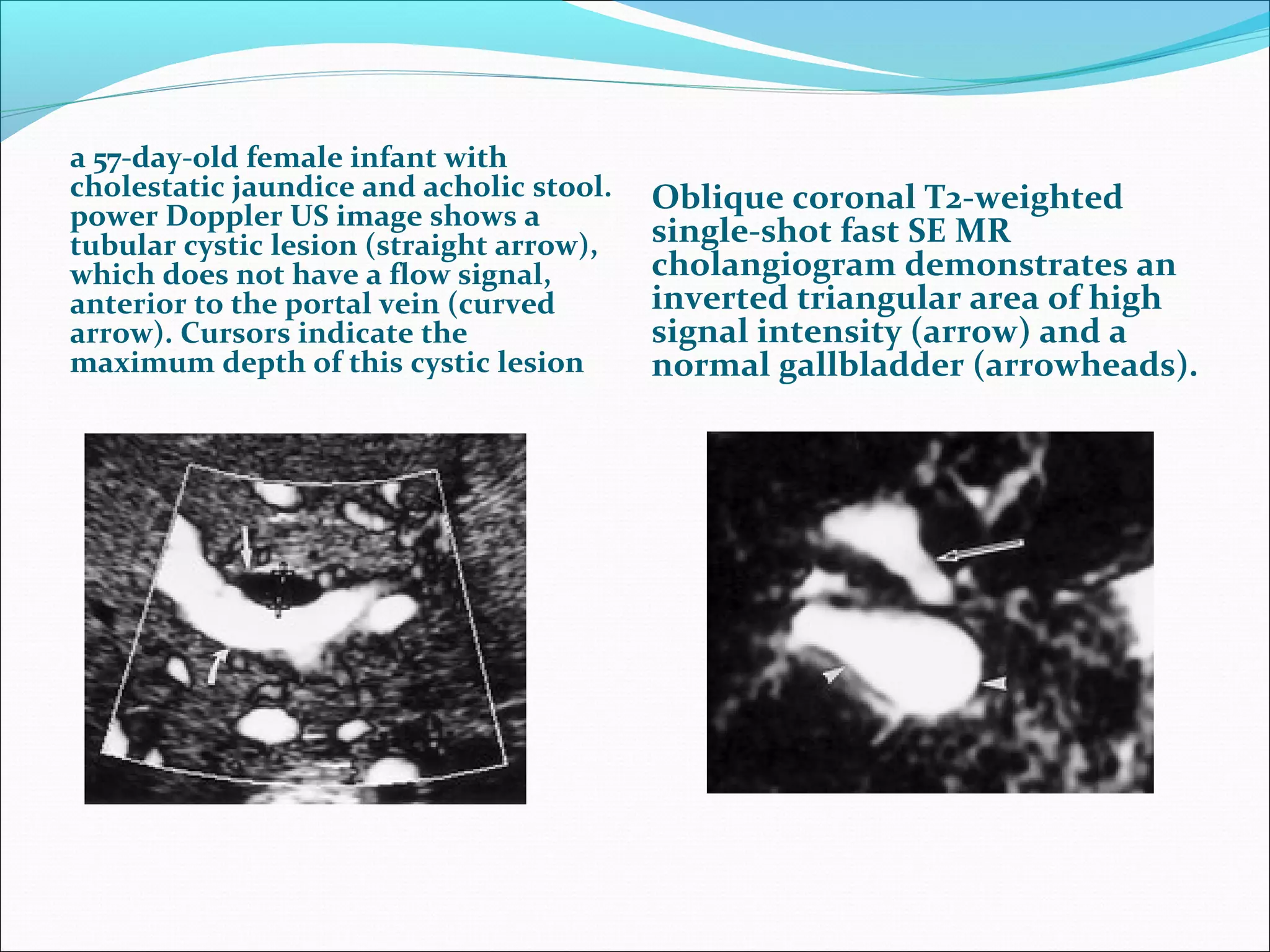 Biliary atresia | PPT