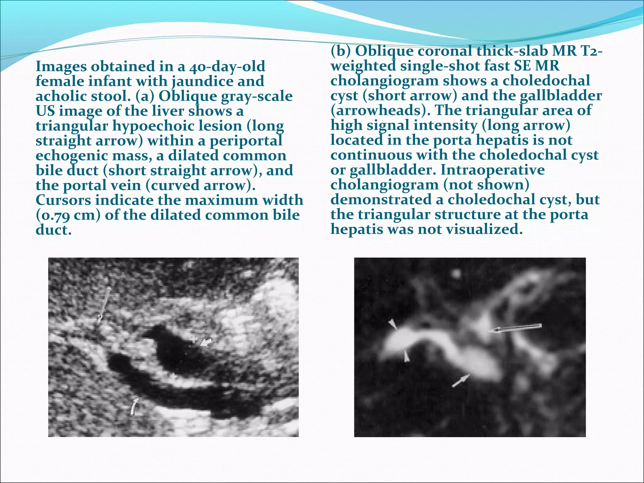 Biliary atresia | PPT