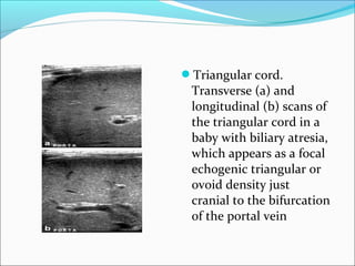 Biliary atresia | PPT