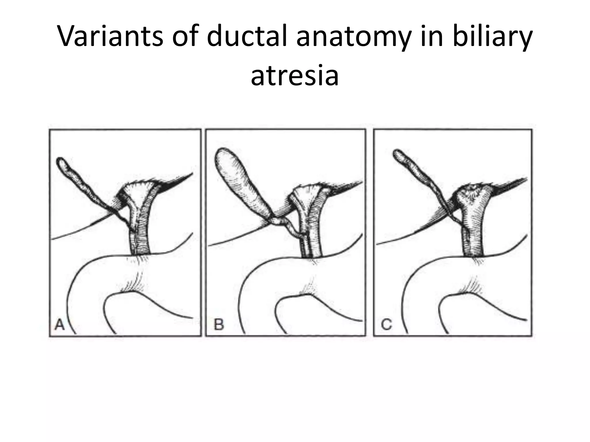 Biliary Atresia | PPTX