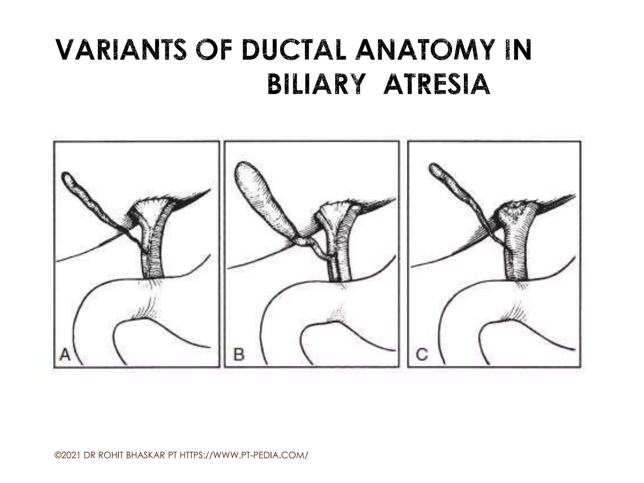 Biliary Atresia - Dr Rohit Bhaskar | PDF