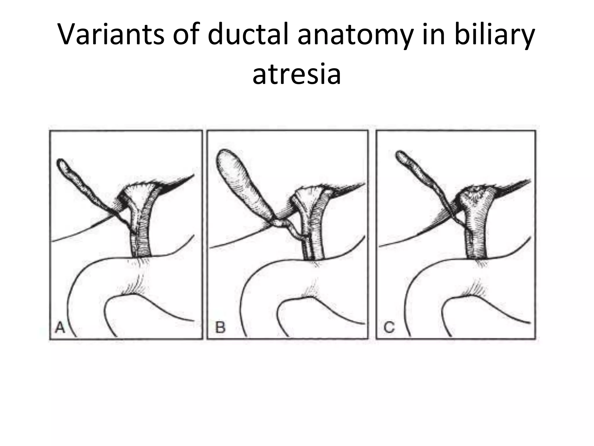 Biliary atresia | PPTX