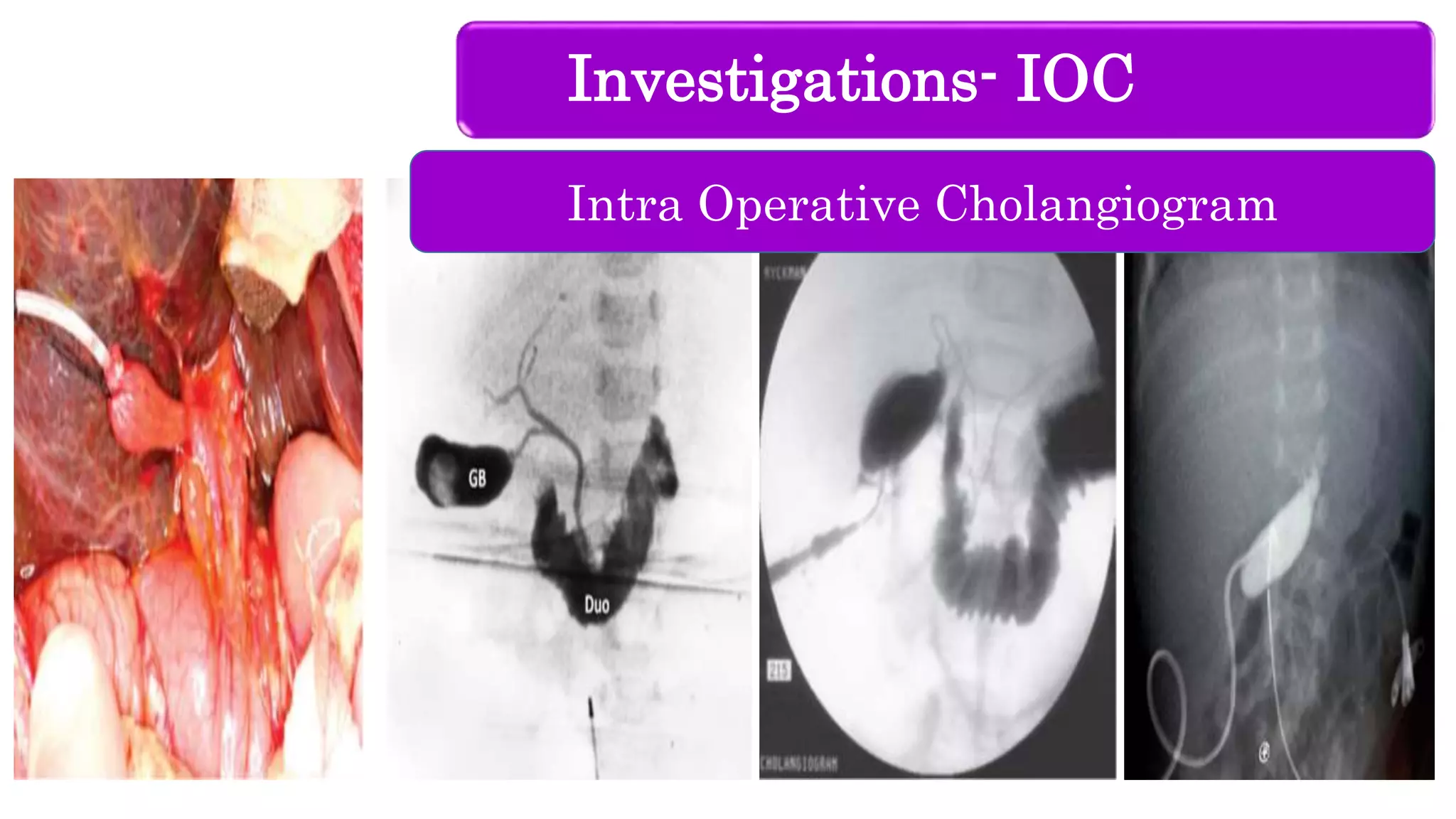 Biliary atresia- Obstructive jaundice/ Pediatric surgery | PPTX
