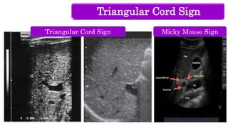 Biliary atresia- Obstructive jaundice/ Pediatric surgery | PPTX