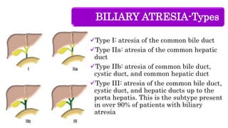 Biliary atresia- Obstructive jaundice/ Pediatric surgery | PPTX