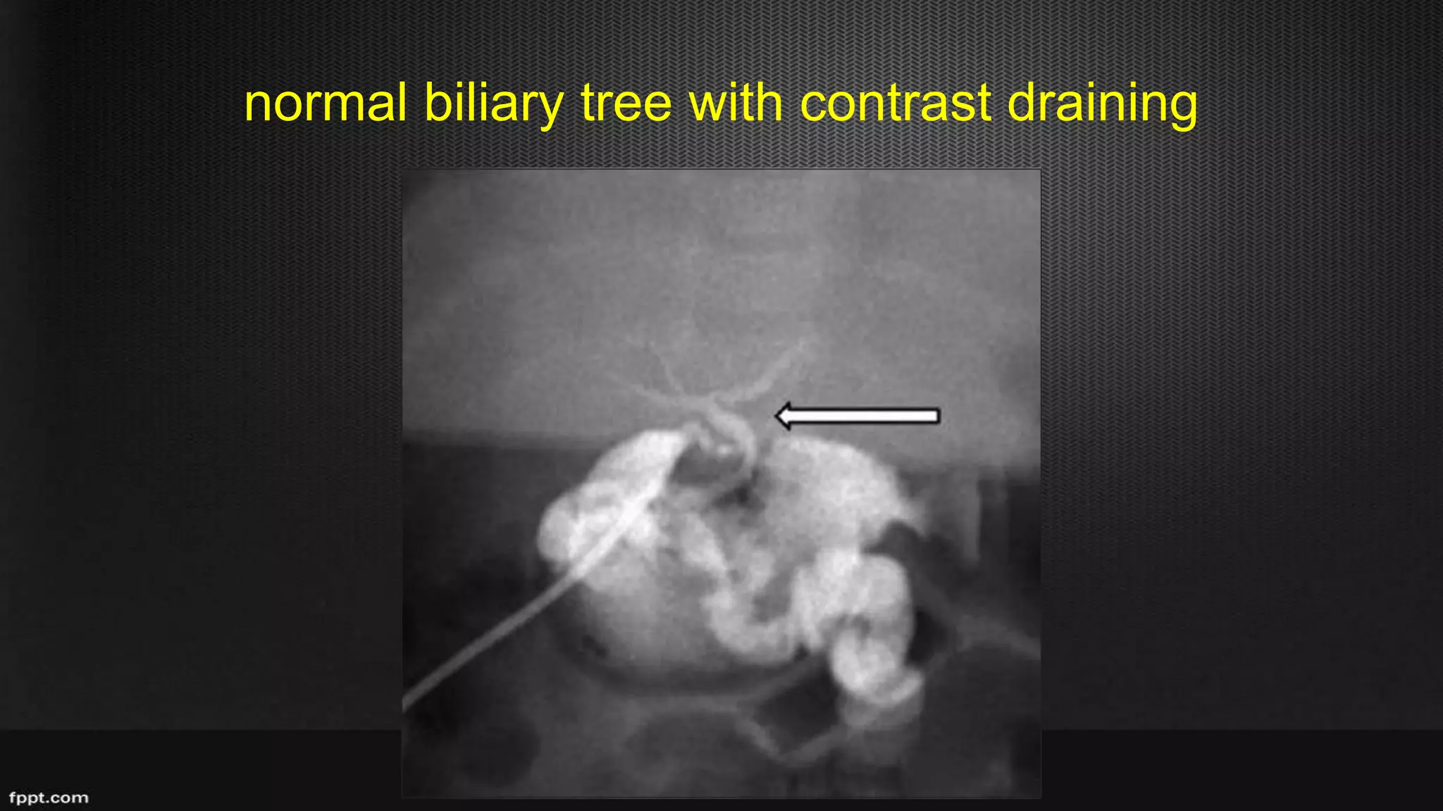 Biliary atresia simplified | PPTX
