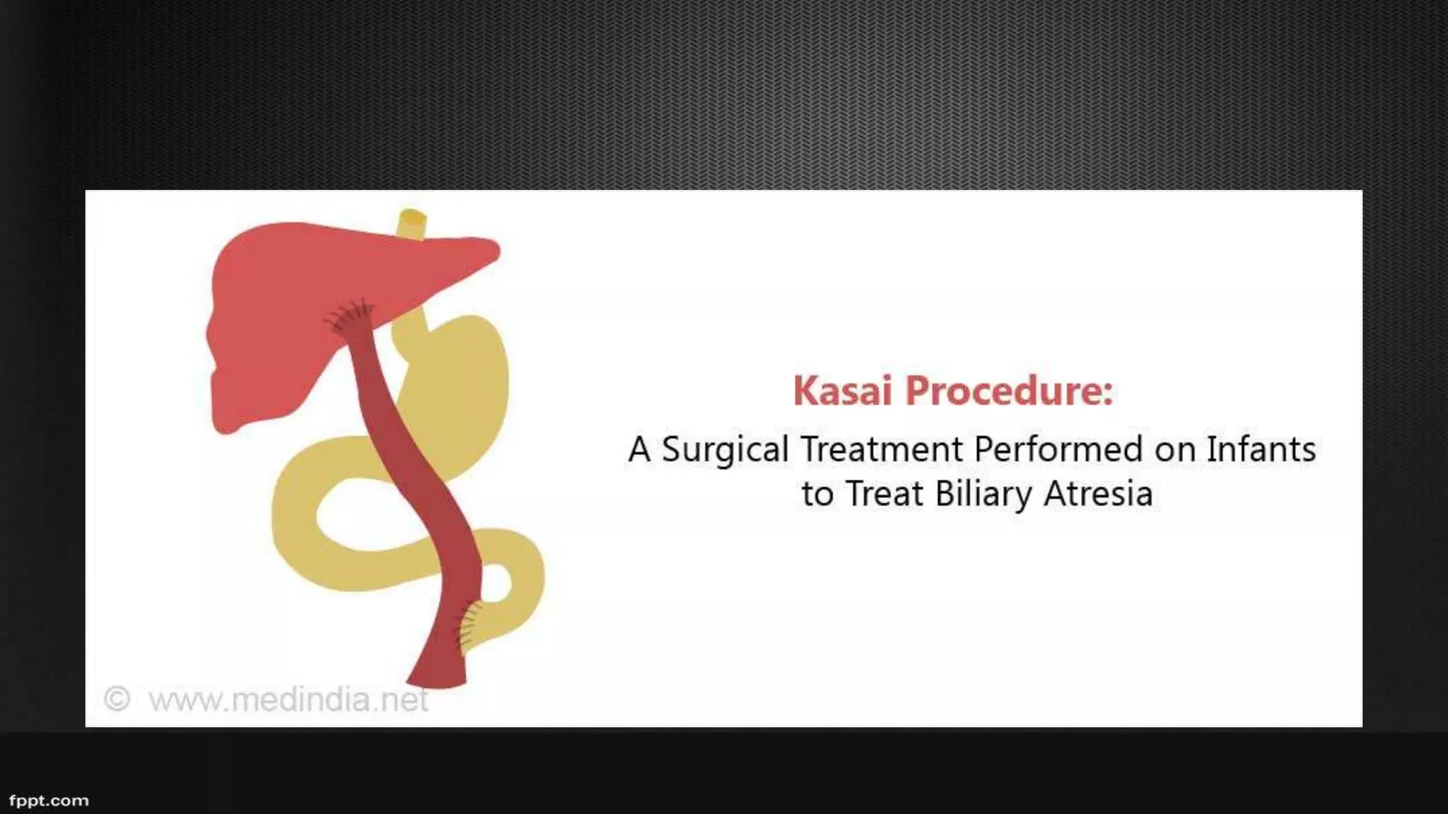 Biliary atresia simplified | PPTX