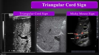 Biliary atresia simplified | PPTX