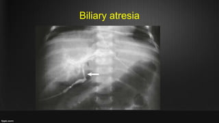 Biliary atresia simplified | PPTX