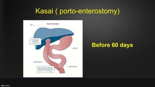 Biliary atresia simplified | PPTX