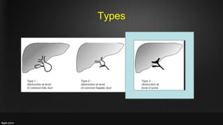 Biliary atresia simplified | PPTX