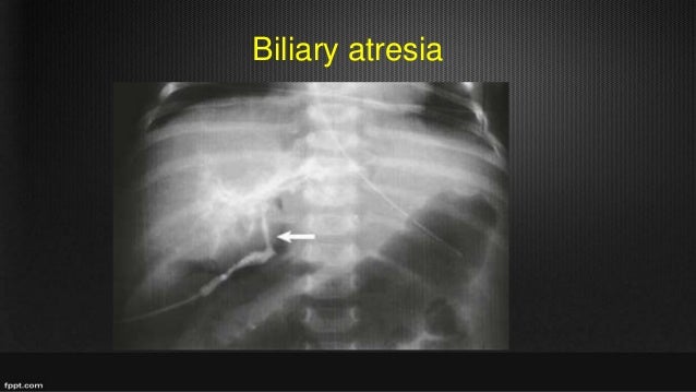 Biliary atresia simplified