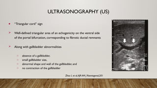 Biliary Atresia : A Rare Congenital Anomaly | PPTX