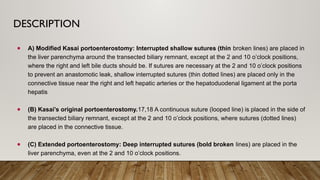 Biliary Atresia : A Rare Congenital Anomaly | PPTX