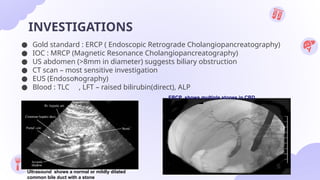 Biliary Tract Diseases including gallstones, CBD stones and ...