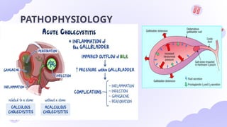 Biliary Tract Diseases including gallstones, CBD stones and ...