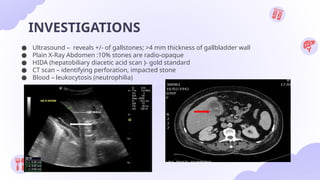 Biliary Tract Diseases including gallstones, CBD stones and ...